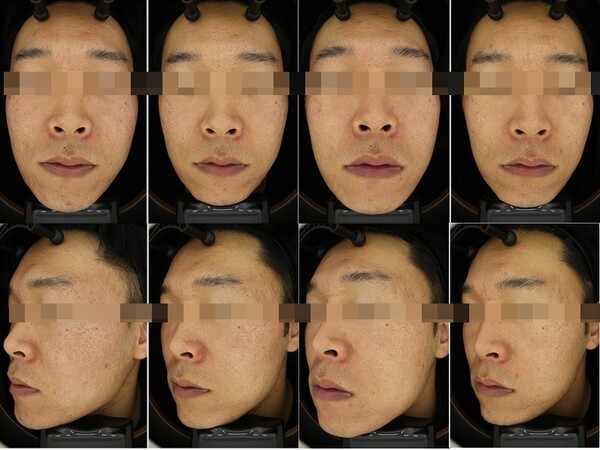 Experience with Acne Scar Treatment Using UltraPulse Encore Laser ②
